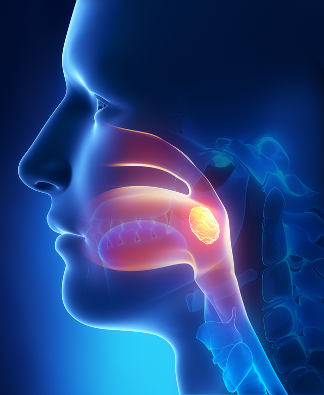 Tonsillektomie-Mandelentfernung – Die HNO Plus Ärzte